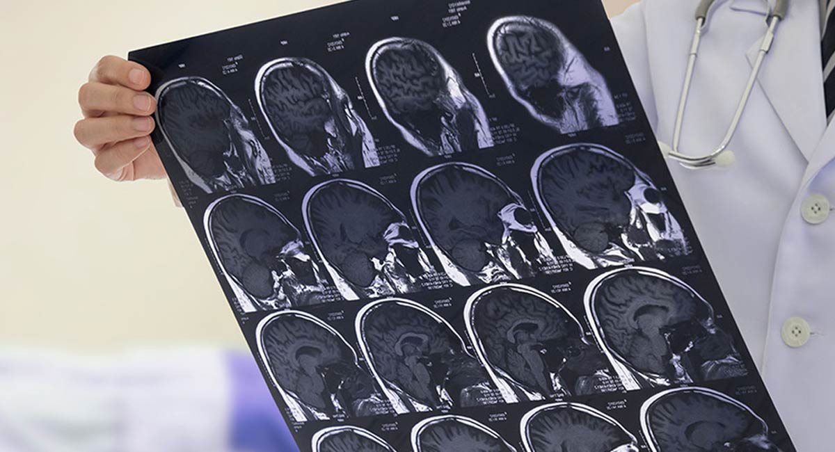Improving care for intracerebral haemorrhage (ICH) patients ...